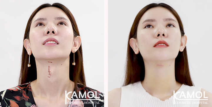 Tracheal Shave - Kamol Hospital