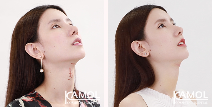 Tracheal Shave - Kamol Hospital