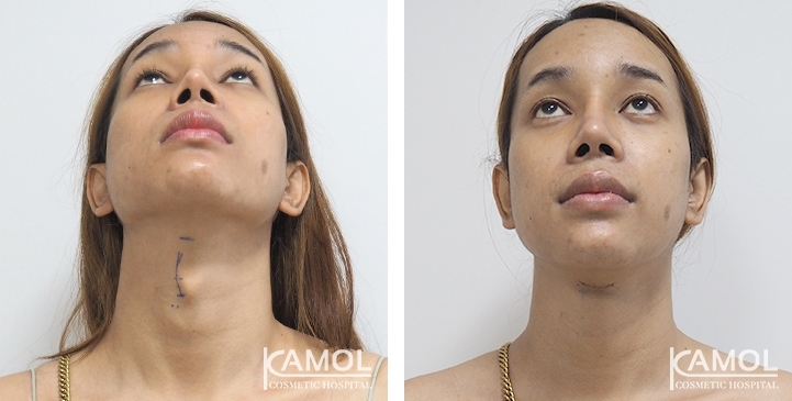Tracheal Shave - Kamol Hospital