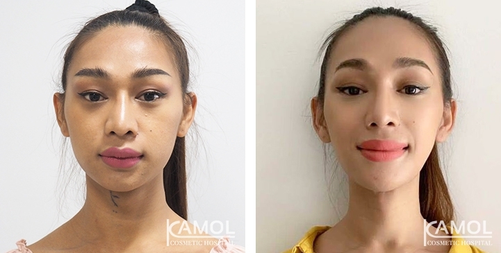 Tracheal Shave - Kamol Hospital