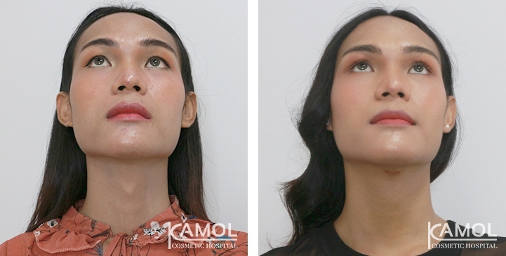 Tracheal Shave - Kamol Hospital