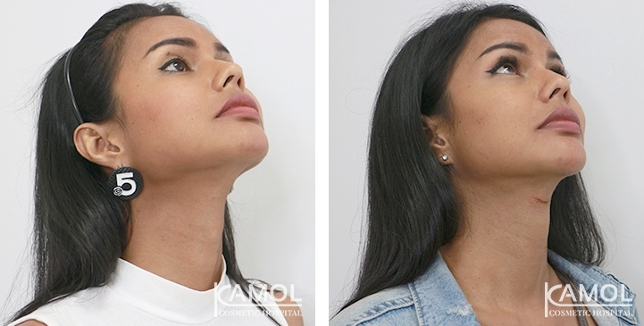 Tracheal Shave - Kamol Hospital