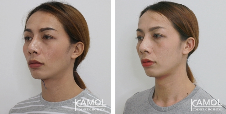 Tracheal Shave - Kamol Hospital