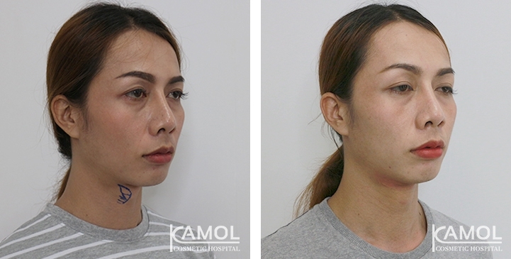 Tracheal Shave - Kamol Hospital
