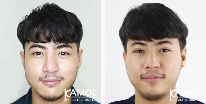 Nose Implant / Augmentation Rhinoplasty - Kamol Hospital