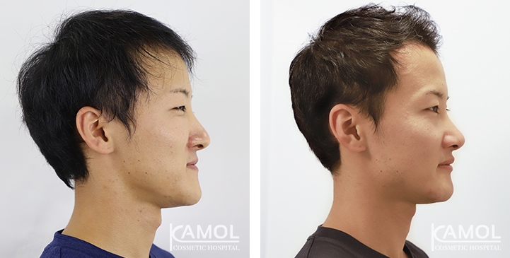 Chin And Jaw Surgery Men